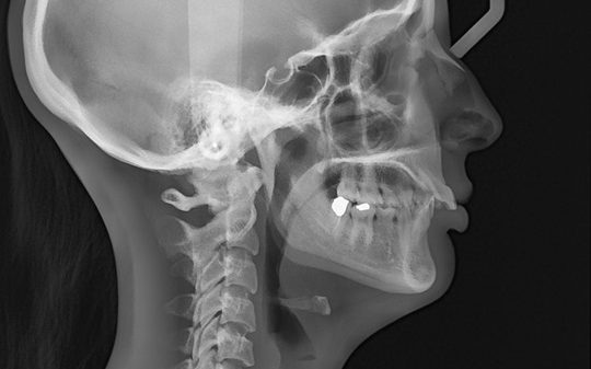 Cephalometric X-Ray – Diş hekimi Ali Ziya Tunçel